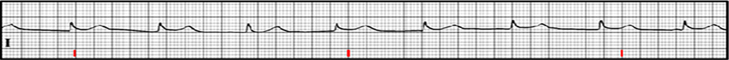 Essential Arrhythmias