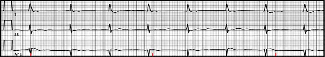 Essential Arrhythmias
