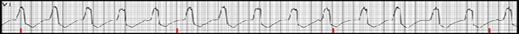 Essential Arrhythmias