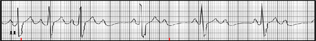 Essential Arrhythmias