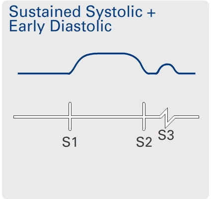 Aortic Stenosis