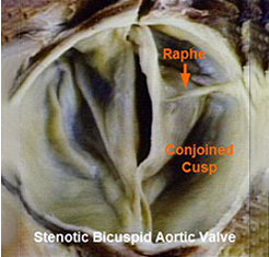 Aortic Stenosis