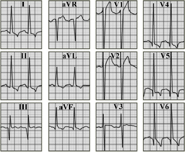 Hypertrophic Obstructive Cardiomyopathy