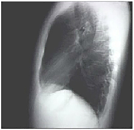 Hypertrophic Obstructive Cardiomyopathy