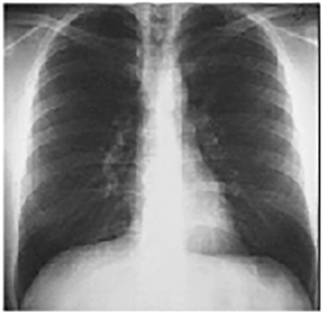 Hypertrophic Obstructive Cardiomyopathy